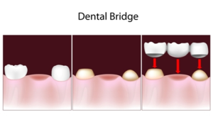 Dental Bridges in Winnipeg, Winkler, Portage La Prairie & Swan River