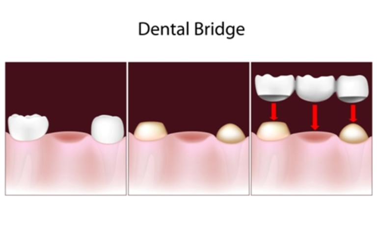 Dental Bridges in Winnipeg, Winkler, Portage La Prairie & Swan River